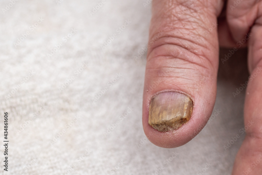 Nail fungus infection on the big finger. Fungal infection on nails hand ...
