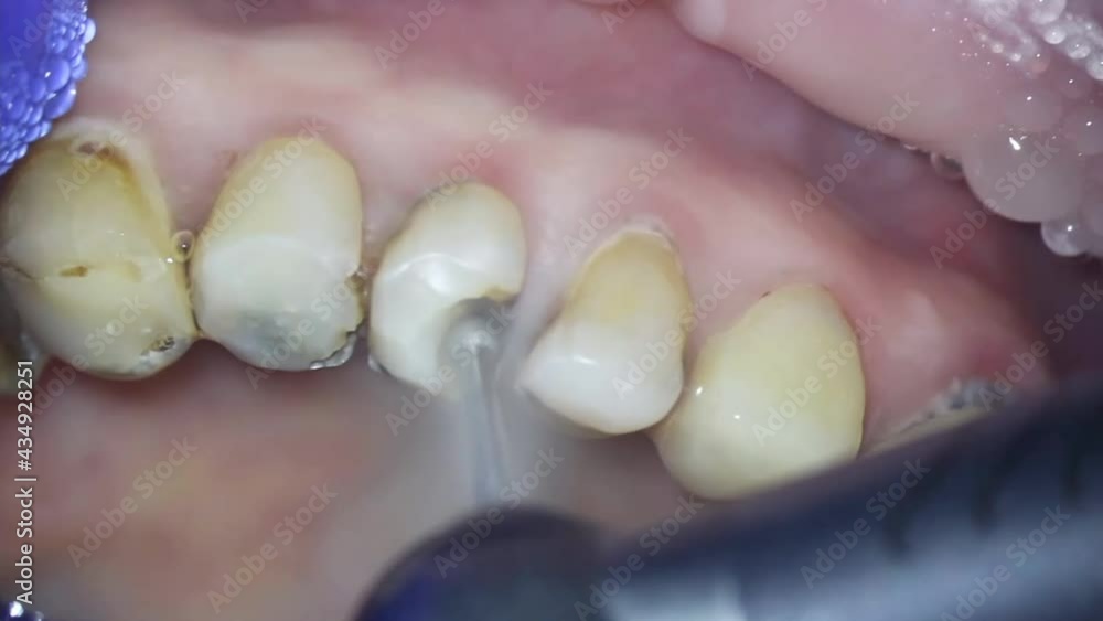 dentistry. shooting with a microscope. necrectomy. the dentist removes ...