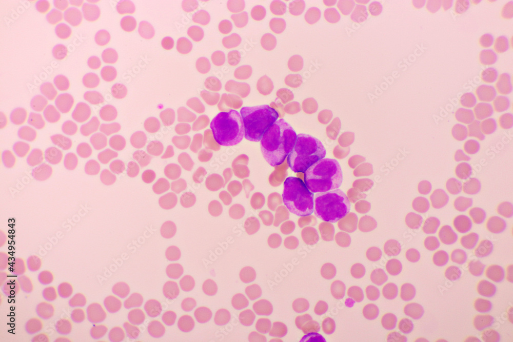 Acute promyelocytic leukemia cells or APL, analyze by microscope ...