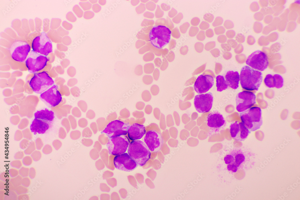Acute promyelocytic leukemia cells or APL, analyze by microscope ...