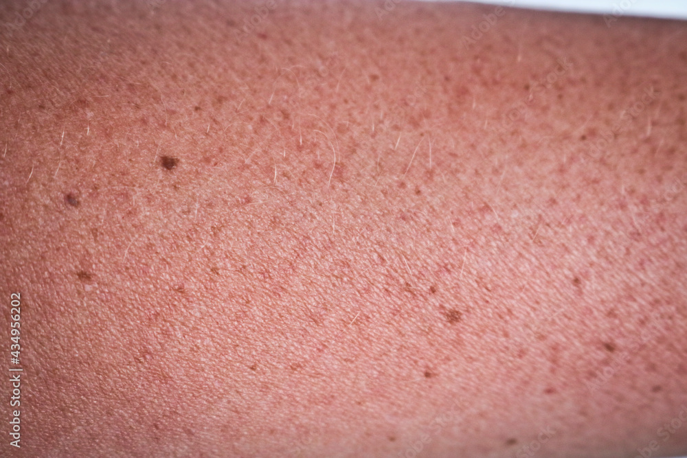 The skin of the hand burnt in the sun. Reddened skin of a woman's hand ...