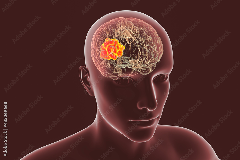 Plagát Brain mucormycosis, a brain lesion caused by fungi Mucor – Obraz ...