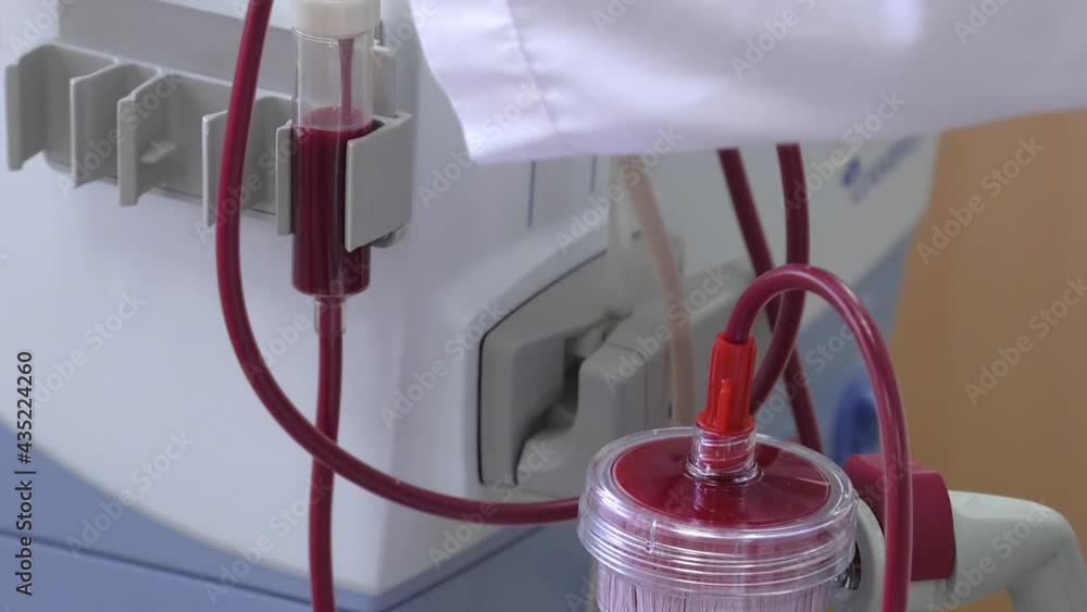 Vidéo Stock Hemodialysis bloodline tubes connected to hemodialysis ...