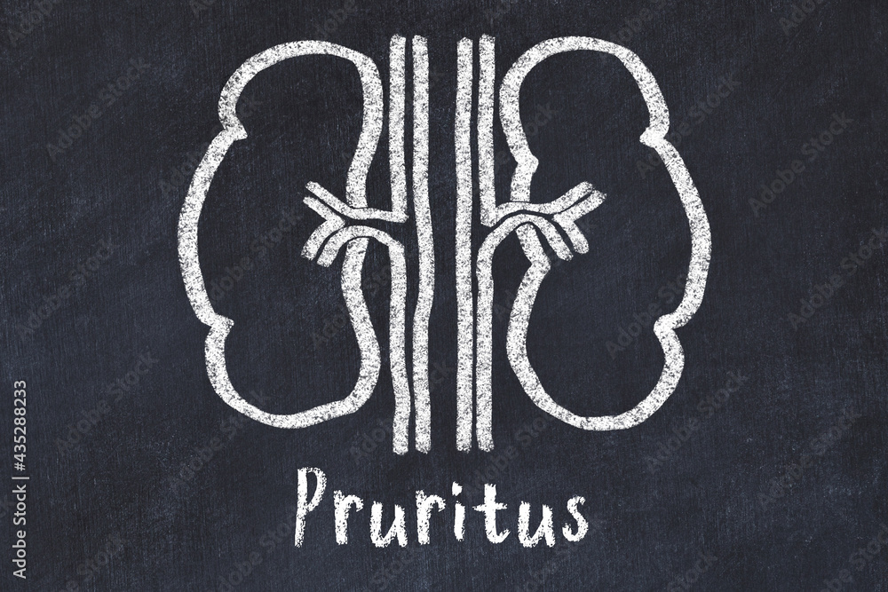 Chalk drawing of human kidneys and medical term Pruritus. Concept of ...