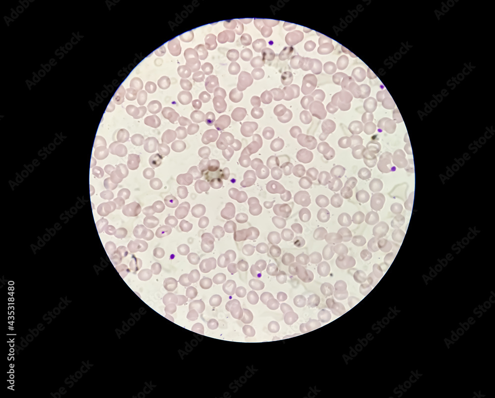 Microscopic blood smear show leucocytopenia or leucopenia a state of ...