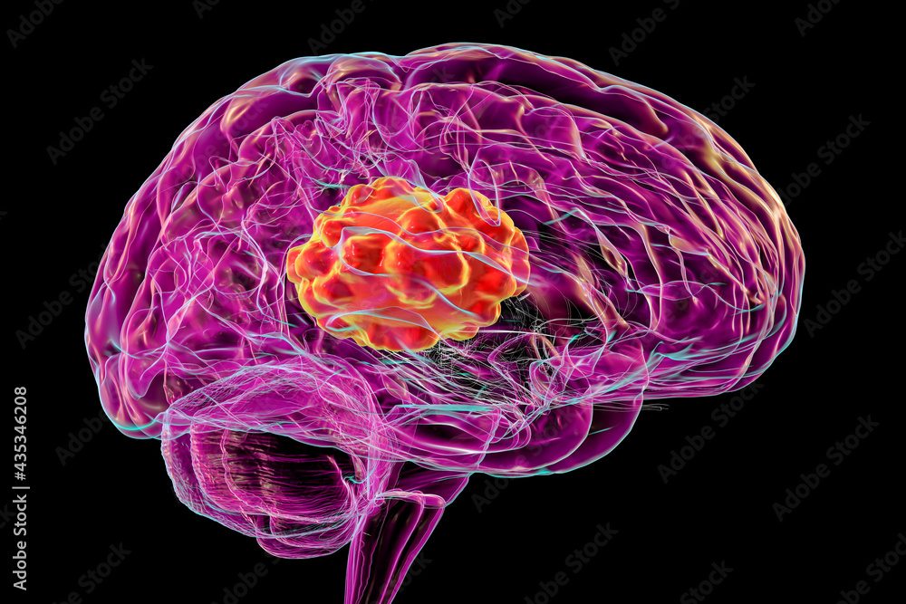 Brain mucormycosis, a brain lesion caused by fungi Mucor, also known as ...