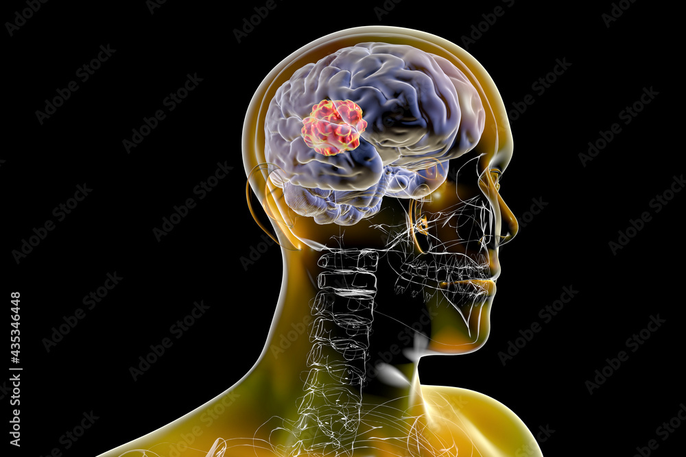 Brain mucormycosis, a brain lesion caused by fungi Mucor, also known as ...