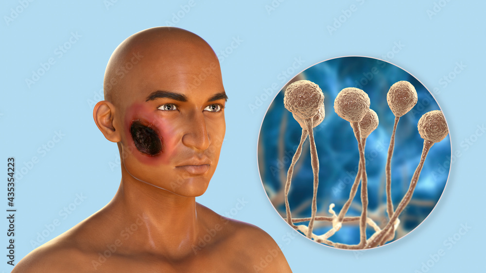 Cutaneous mucormycosis, or skin mucormycosis, a disease caused by fungi ...
