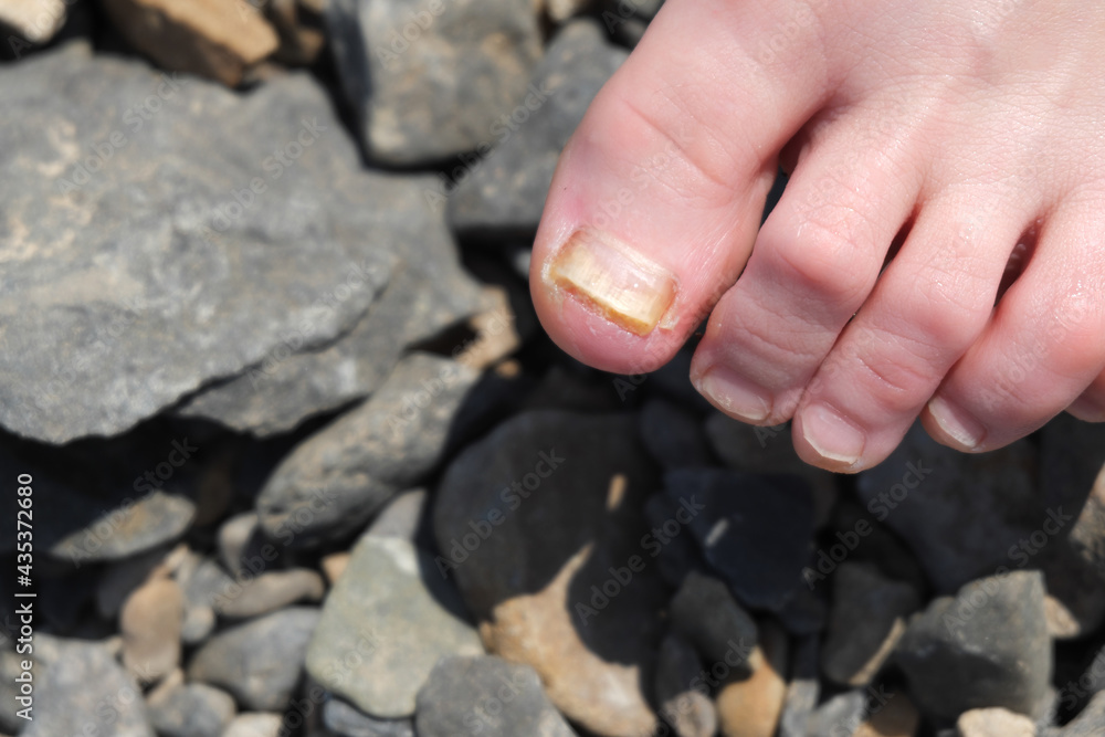 Fungal nail disease. Toenail damaged by an intractable fungal disease ...