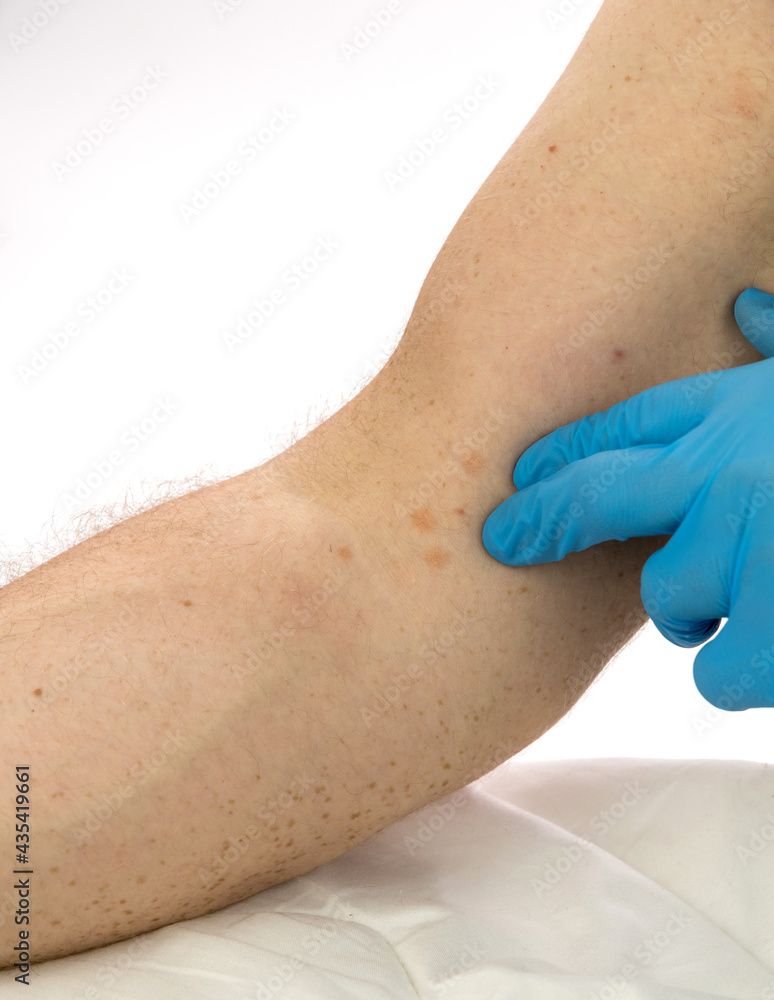 Tinea in a mans armpit beeing inspected Stock Photo | Adobe Stock
