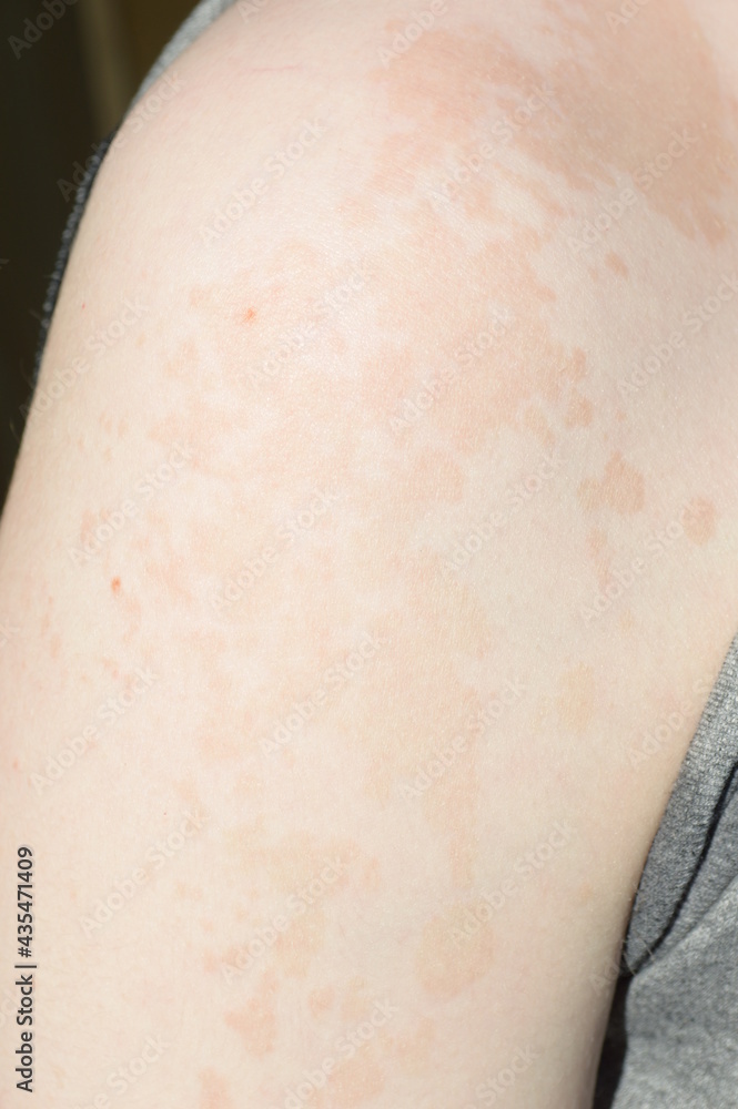 Fungus on human skin, on the hand on the neck. Stock Photo | Adobe Stock