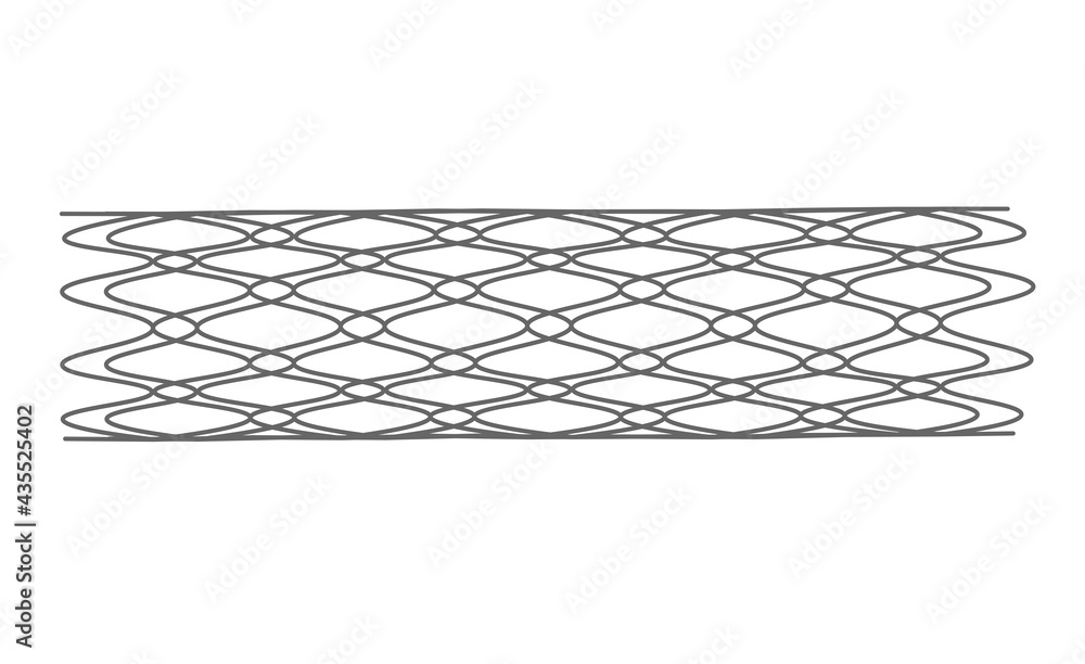 Endovascular metal Stent illustration. Expanded stent Stock ...