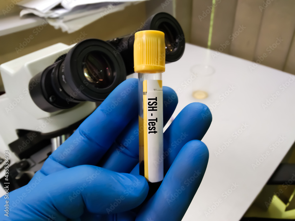 Blood sample for thyroid stimulating hormone (TSH) test Stock Photo ...