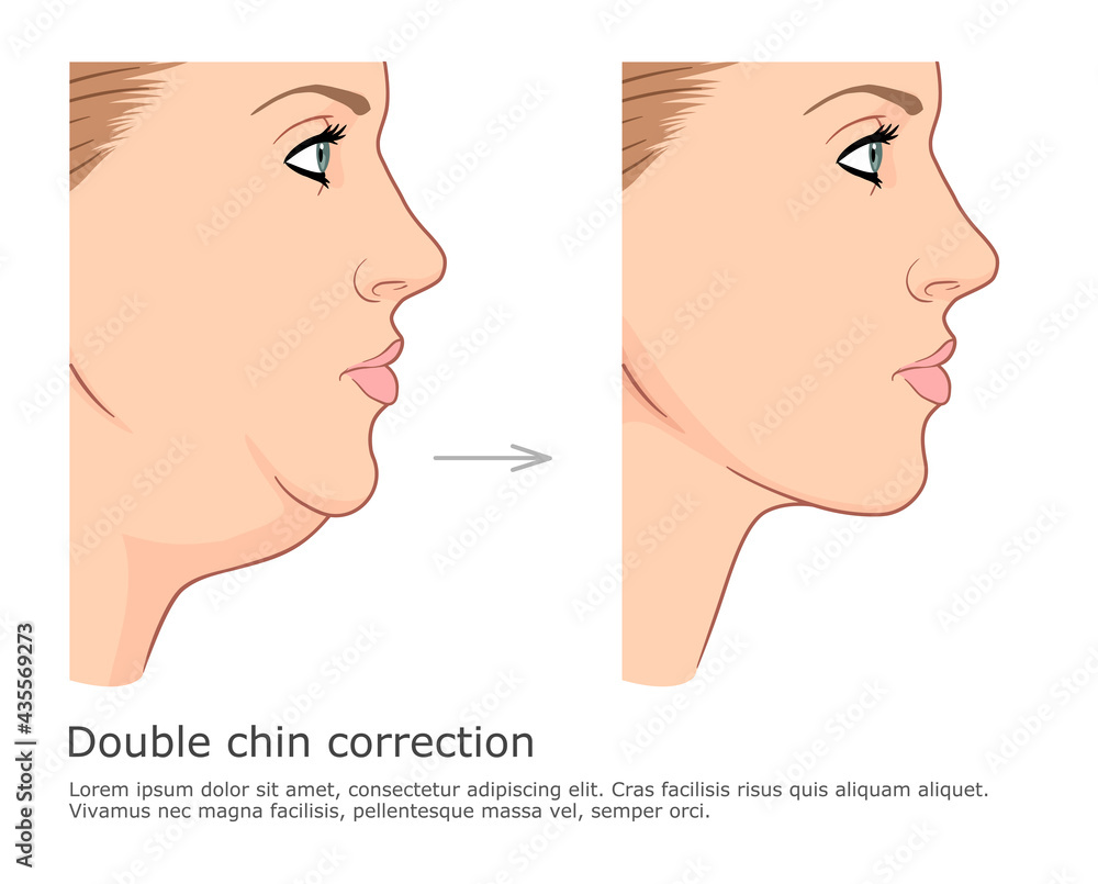Fat chin and neck correction before and after. Double chin fat loss ...