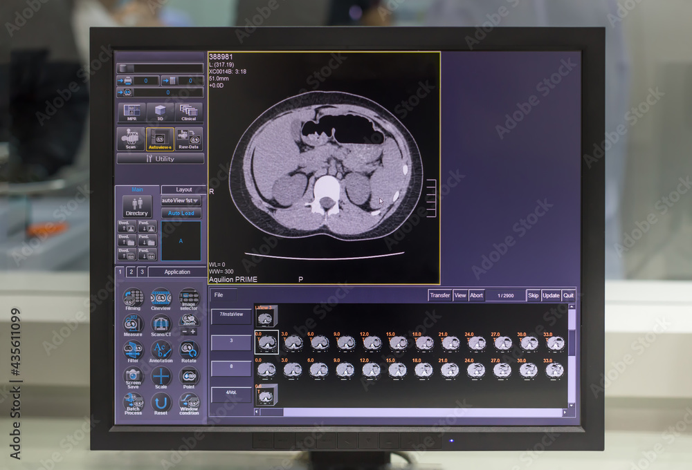Computer Screen Showing MRI, CT Image Scan of the Brain. CT whole ...
