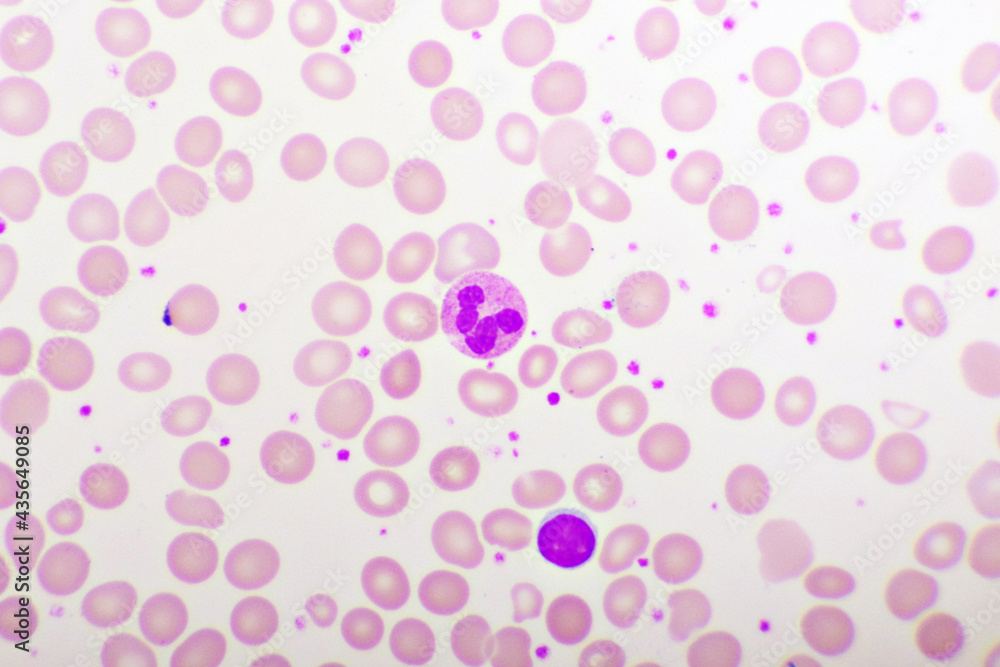 Essential thrombocytosis blood smear, present abnormal high platelet ...