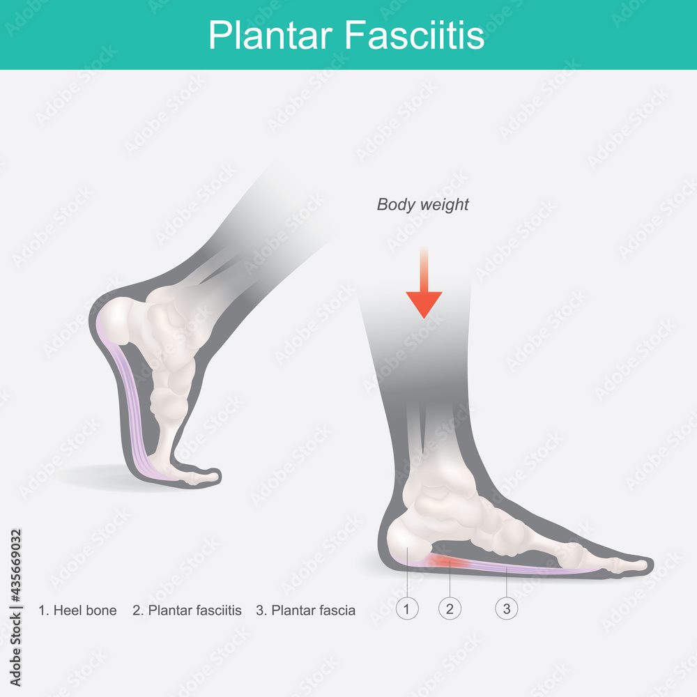 Plantar Fasciitis. Illustration human foot anatomy explain on symptom ...