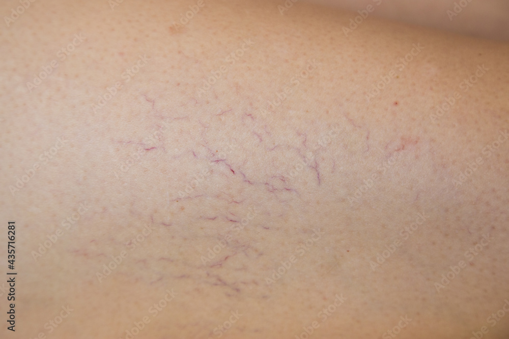 Spider veins on leg. Varicose veins. swelling of the veins on the legs ...