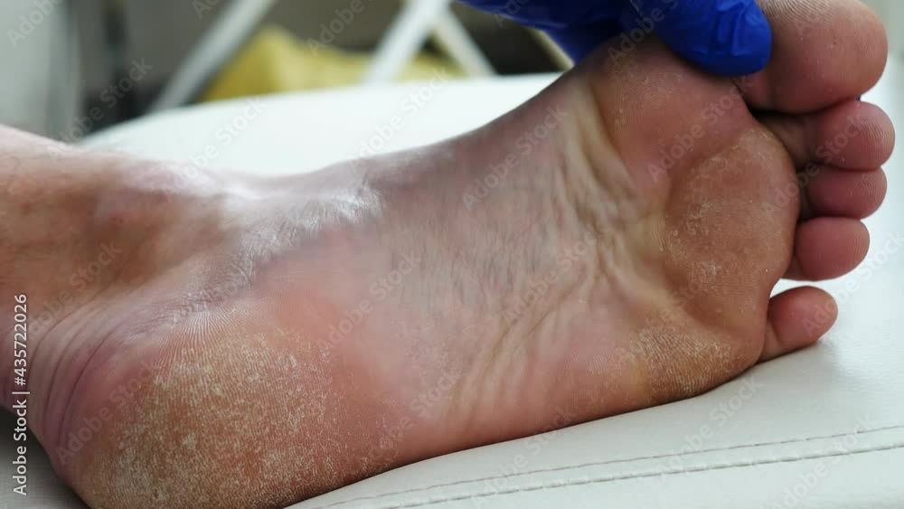 Human foot with dry skin. Dry skin, Psoriasis of the feet. The skin is ...