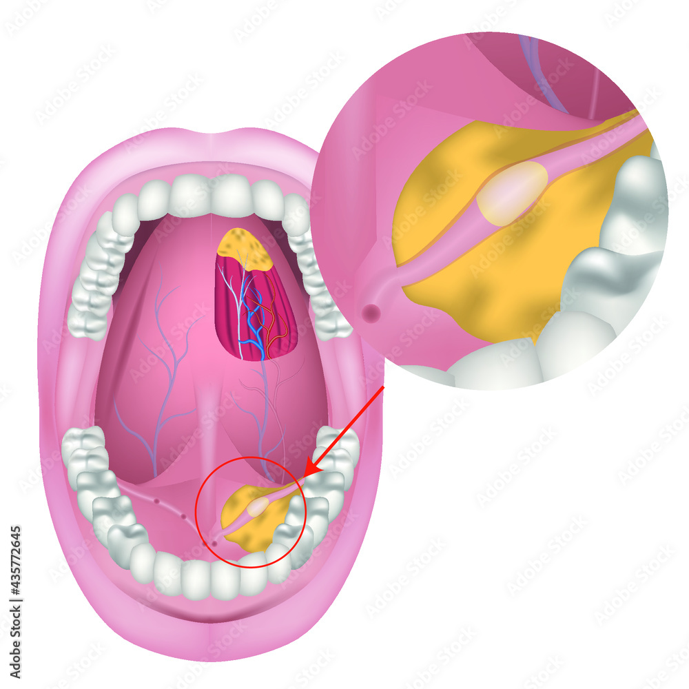 Stone in the ducts of the salivary glands. Diagram showing neoplasm ...