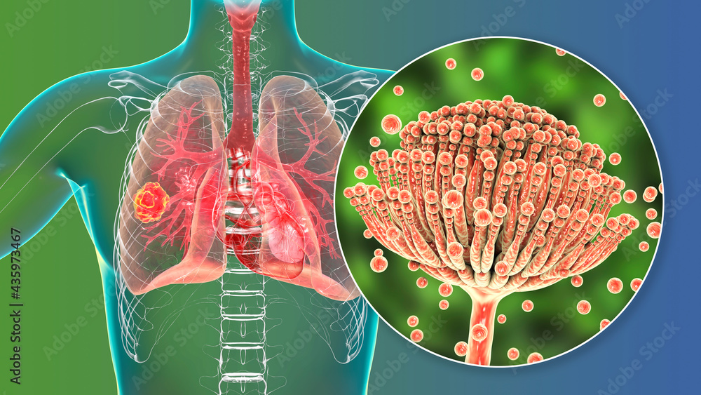 Pulmonary aspergillosis, invasion of a lung tissue by mold fungi ...