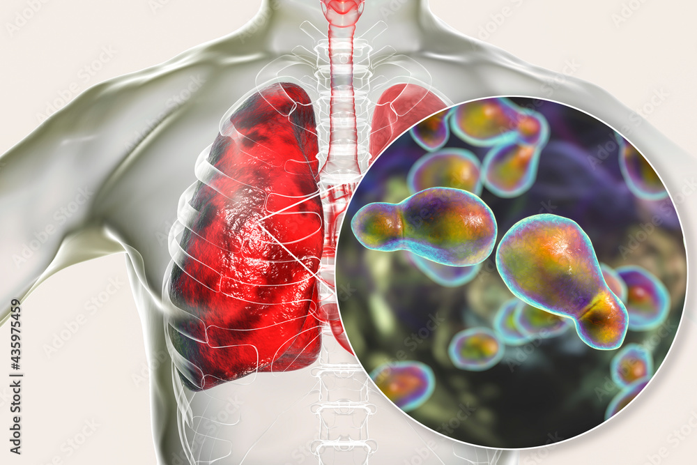 Pulmonary cryptococcosis, invasion of a lung tissue by yeast fungi ...