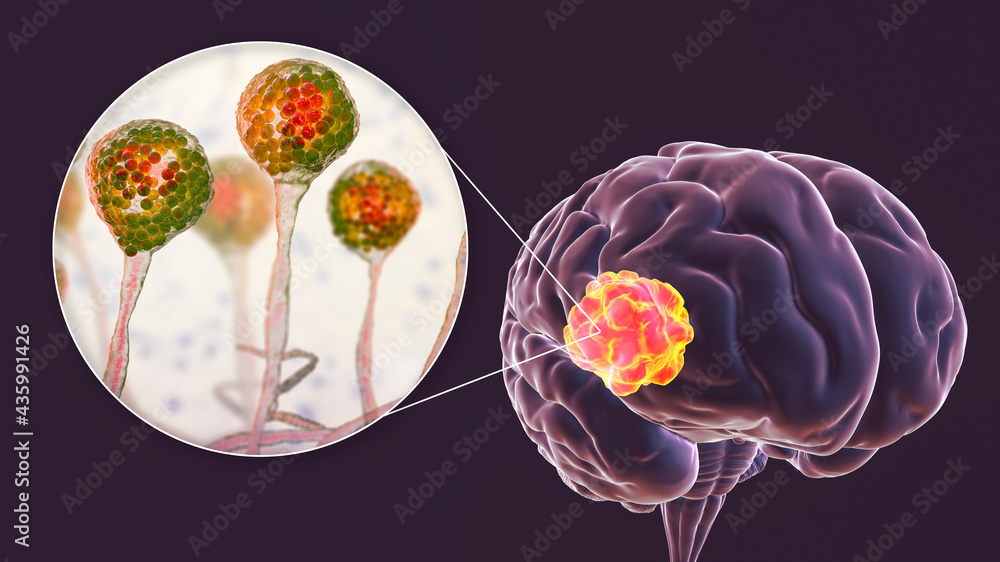 Brain mucormycosis, a brain lesion caused by fungi Mucor, also known as ...