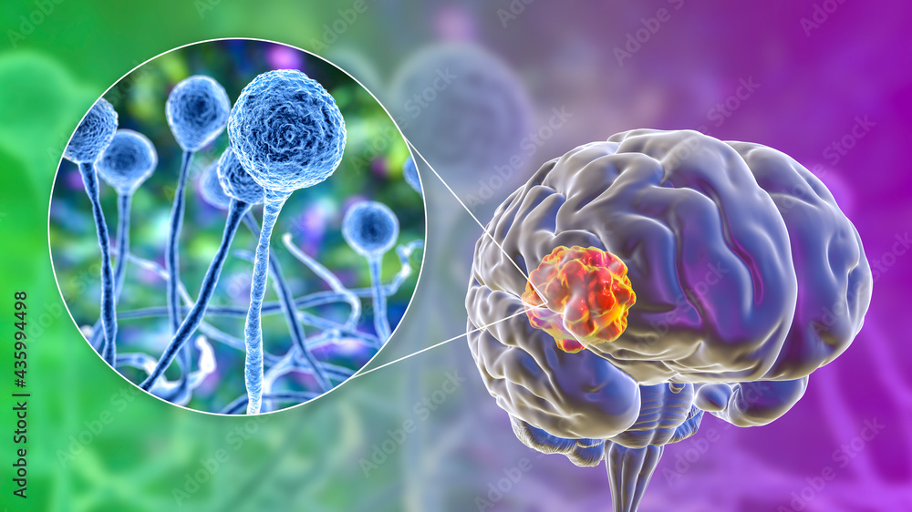 Brain mucormycosis, a brain lesion caused by fungi Mucor, also known as ...