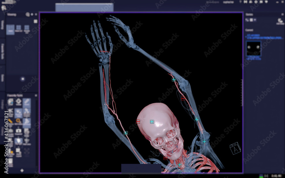 CTA brachial artery or CT scan of upper extremity or the Arm 3d ...