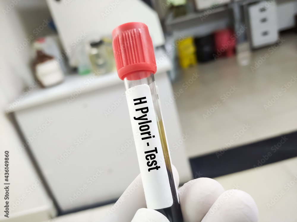 Blood sample for Helicobacter pylori (H.pylori) test Stock Photo ...