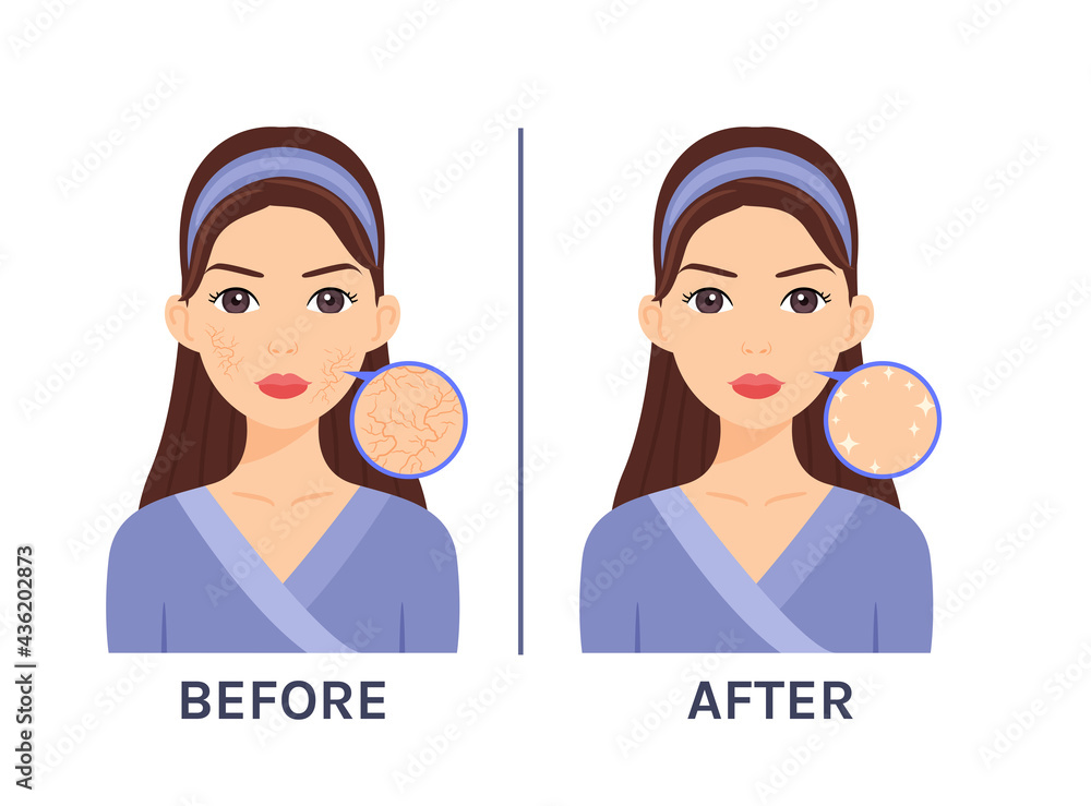 Cute Girl and Dry Skin on her Face. Before and after.Cracked skin and ...