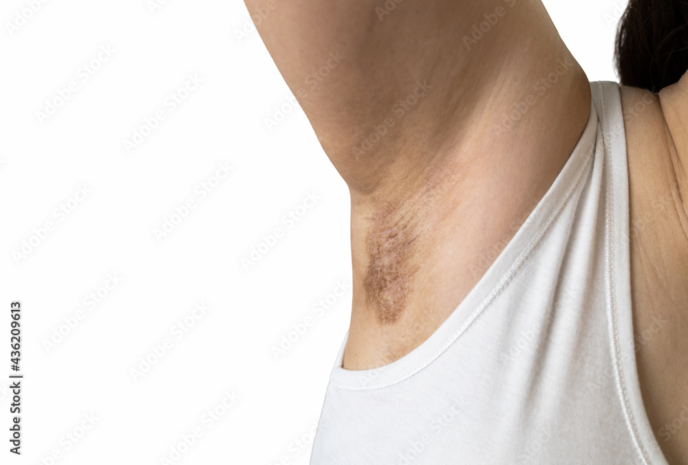 Asian lady girl showing a scar on the skin of the armpits,marks after ...