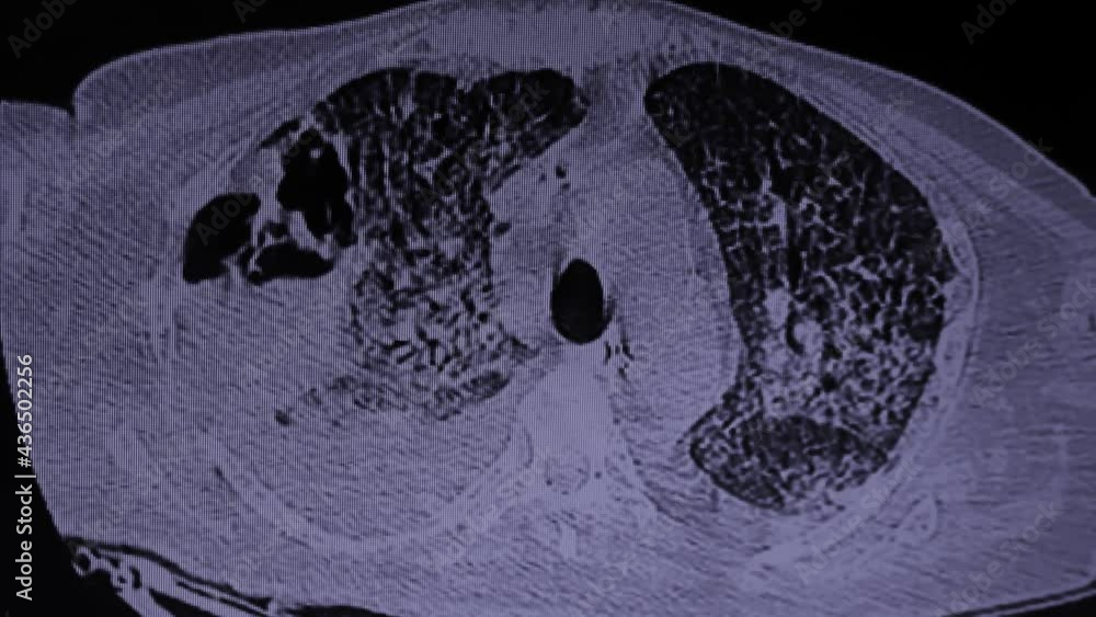 CAT-Scan video of a patient with SARS-Co-V2 COVID-19 and cavity with ...