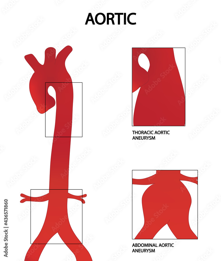 Aortic Aneurysm illustration. Abdominal and Thoracic Aortic aneurysm ...