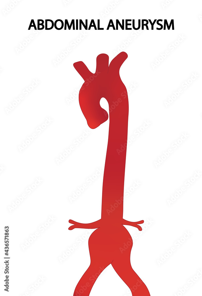 Aortic Aneurysm illustration. Abdominal Aortic aneurysm Stock ...