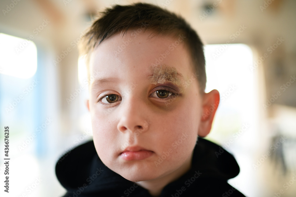 Poor sad small boy with cut eyebrow standing indoors at home, poverty ...