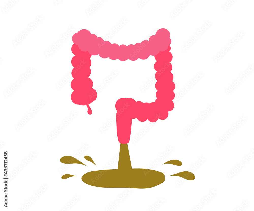 Large intestine on a white background. Diarrhea. Vector illustration ...