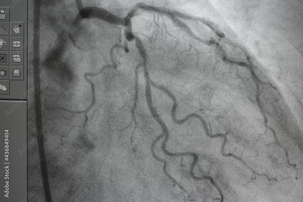Coronary angiography, Coronary artery disease. Medical x-ray of heart ...