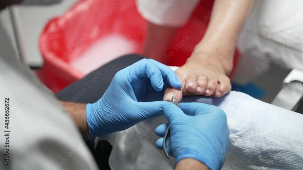 A professional medical pedicure doctor helps to prevent ingrown nail in ...