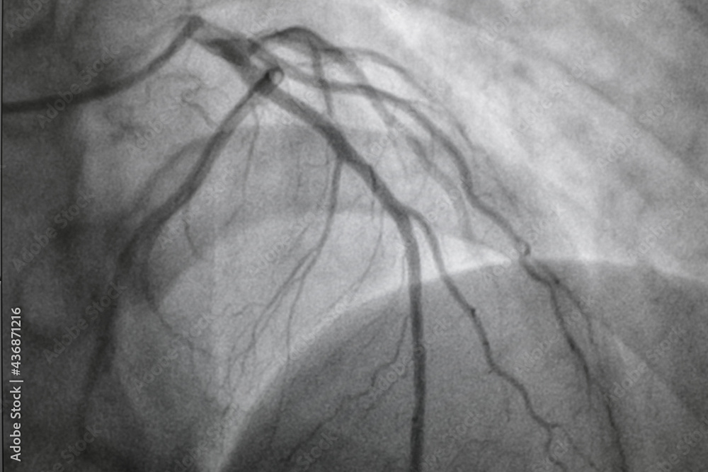 Coronary angiography, Coronary artery disease. Medical x-ray of heart ...