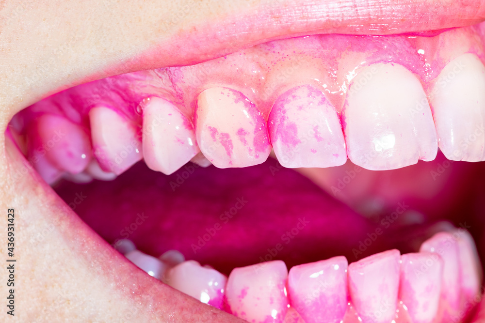 Concept of deep and detailed cleaning of the teeth. Pink disclosing ...