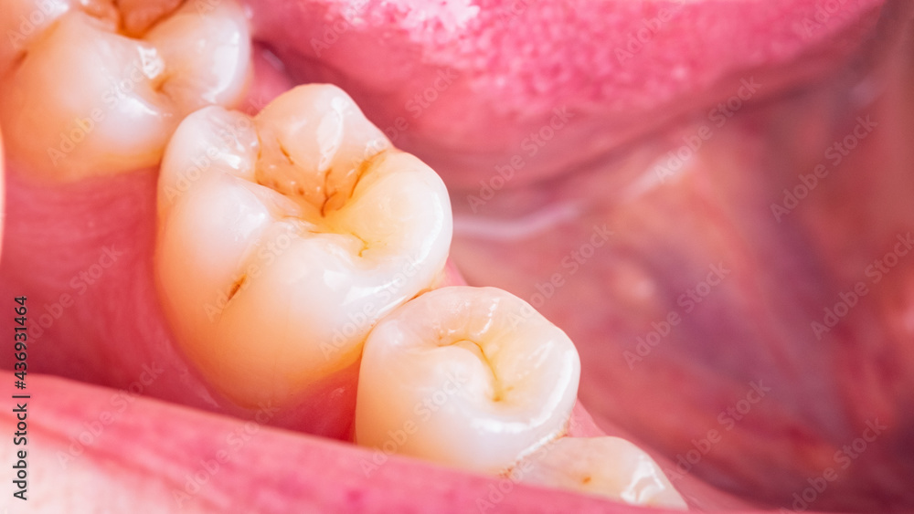 Tooth Erosion Symptoms