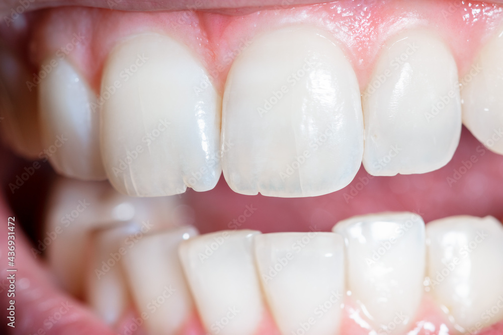 Concept of microfractures on the dental surface. Slight superficial ...