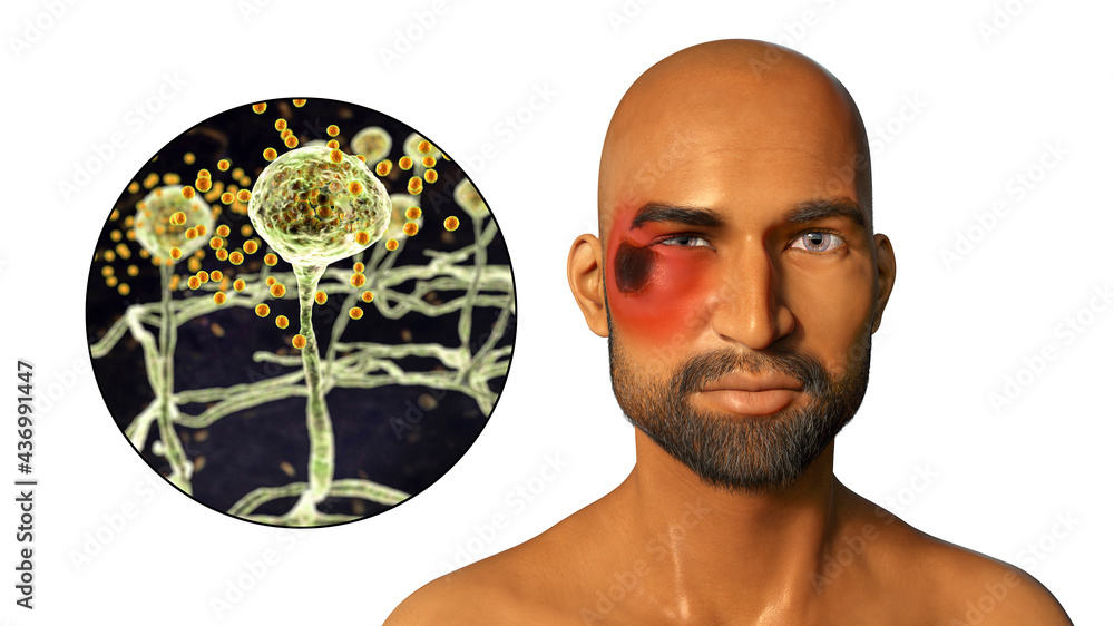 Cutaneous Mucormycosis