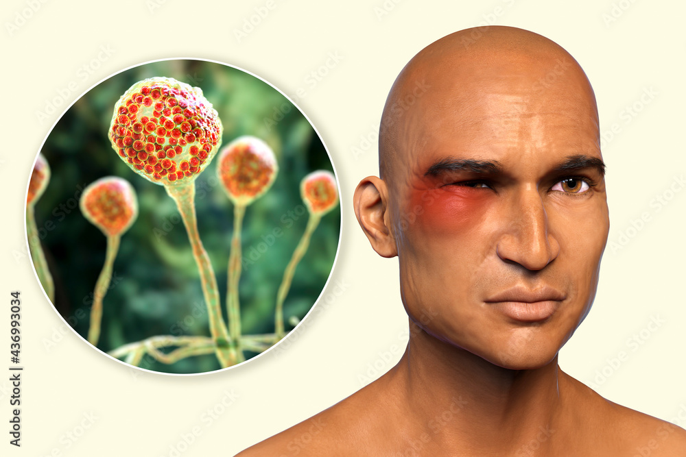 Periorbital cutaneous mucormycosis, a disease caused by Mucor fungi ...