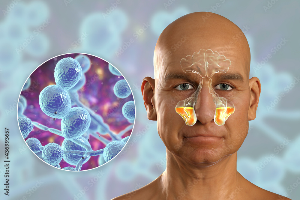 Sinusitis, inflammation of paranasal cavities, 3D illustration Stock ...