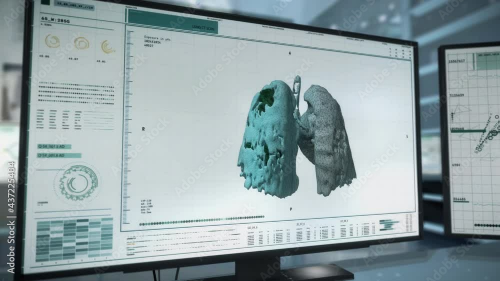 Modern User Interface Of Medical Program To Analyse Lungs Condition. 3d ...