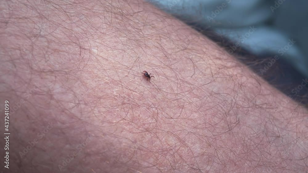 Small Insect Parasite Mite Crawls On a Man's Leg. Tick on the Skin ...