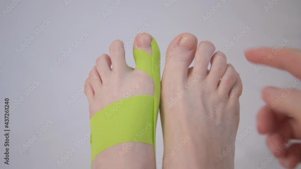 Feet close-up, top view. There is a tap on the big toe. Correction of ...