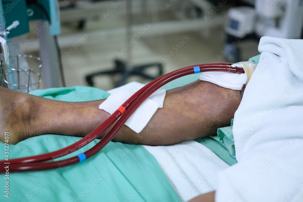patient's leg with extracorporeal membrane oxygenation line (ECMO) on ...
